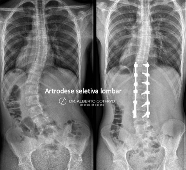 Cirurgia de escoliose - Médico especialista em coluna - Dr. Alberto Gotfryd