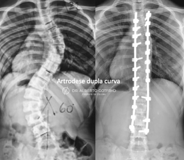 Cirurgia de escoliose - Médico especialista em coluna - Dr. Alberto Gotfryd