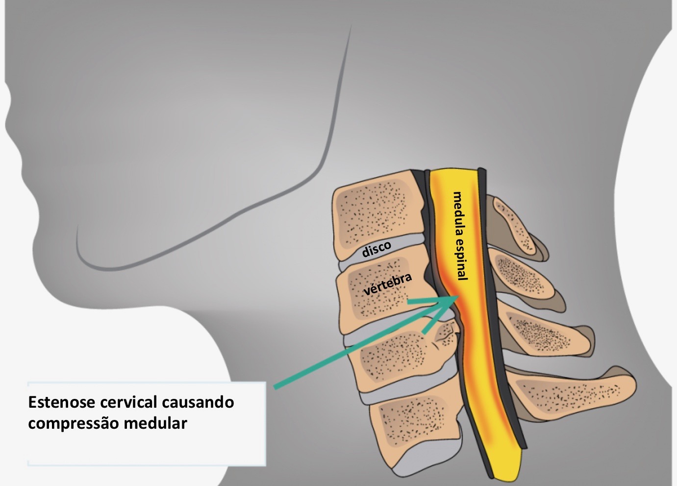 Estenose cervical: entenda o problema - Dr. Alberto Gotfryd