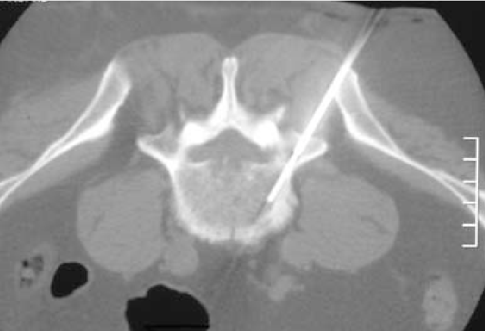 Espondilodiscite em adultos - Dr. Alberto Gotfryd