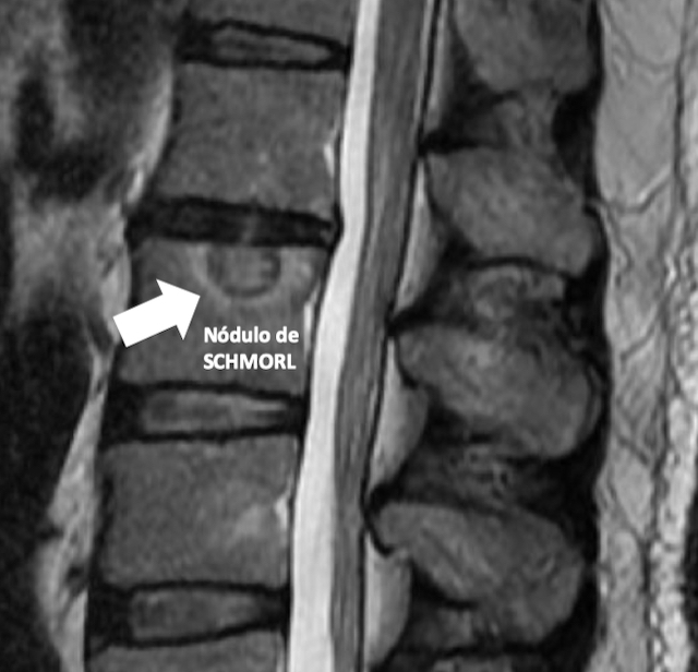 Nódulo de Schmorl: o que é, sintomas e tratamento - Dr. Alberto Gotfryd