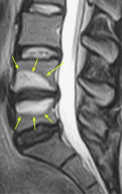 Lesões de Modic: o que é, tipos, sintomas e tratamentos - Dr. Alberto Gotfryd
