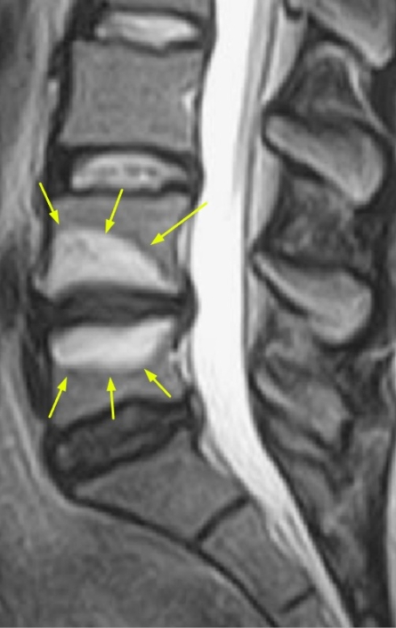 Lesões de Modic: o que é, tipos, sintomas e tratamentos - Dr. Alberto ...