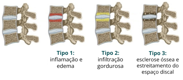Lesões de Modic: o que é, tipos, sintomas e tratamentos - Dr. Alberto ...